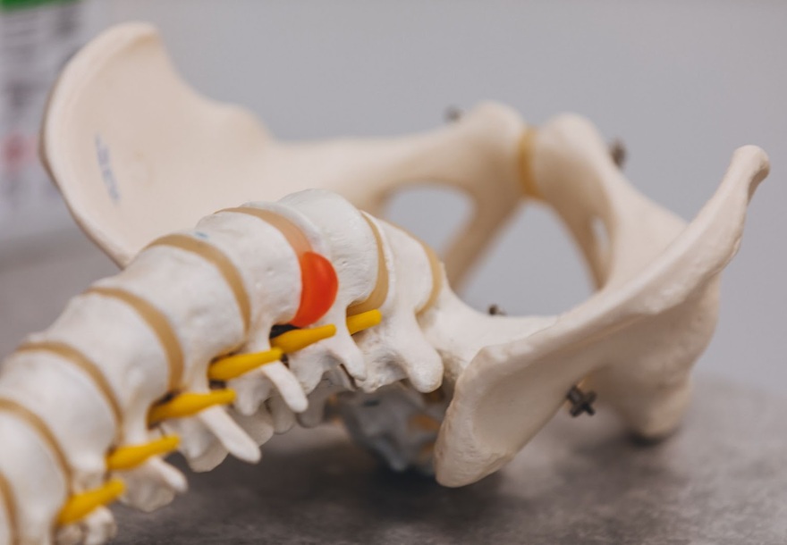 Czym jest dyskopatia? Objawy i leczenie